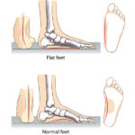 Pes Planus Uncovered - 5 Steps To Strengthen Your Feet